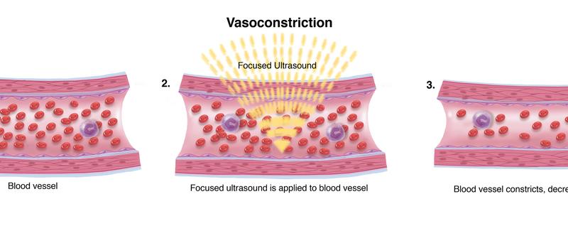 Digital vasoconstriction is the narrowing of blood vessels | The Fact Base